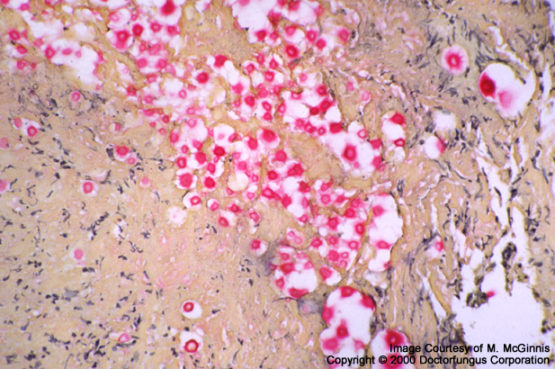 Histopathology - Doctor Fungus