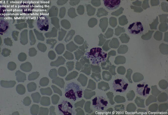 Histoplasmosis due to Histoplasma capsulatum - Doctor Fungus