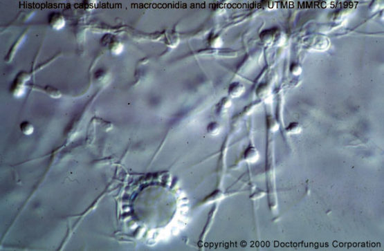 Histoplasmosis due to Histoplasma capsulatum - Doctor Fungus