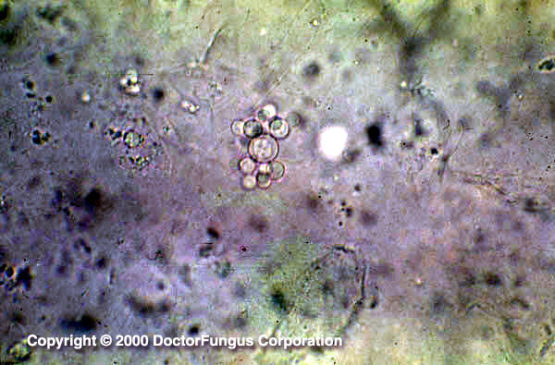 Paracoccidioides Species - Doctor Fungus