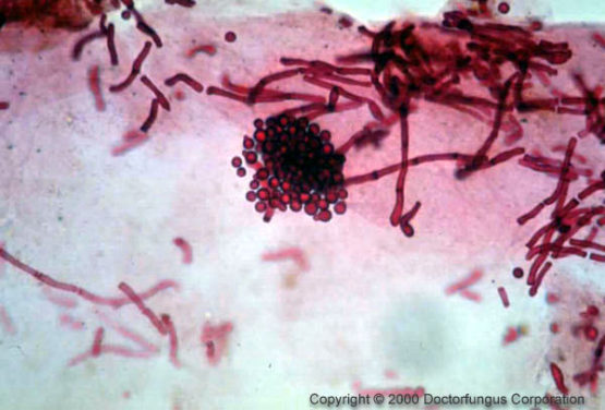 pas_skin_m_furfur - Doctor Fungus