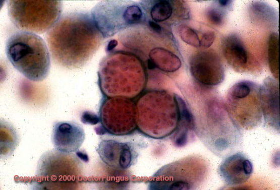 Coccidioidomycosis - Doctor Fungus