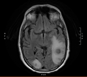 Figure 2B Brain MRI T2 weighted (axial) at the time of CNS Aspergillus ...