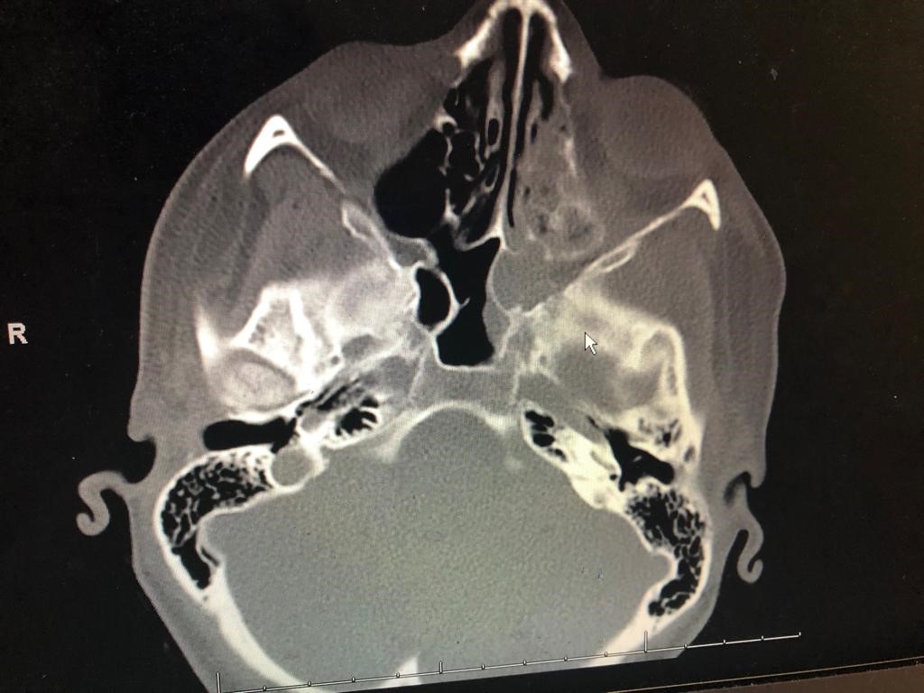 CT maxillofacial wo contrast Image 2B - Doctor Fungus