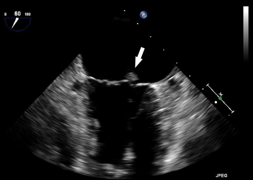 Figure 2 Asp. Endocarditis TEE - Doctor Fungus