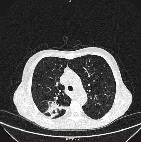 Figure-5_CT-scan-Day-65-showing-stable-infiltrate-in-right-dorsobasal ...